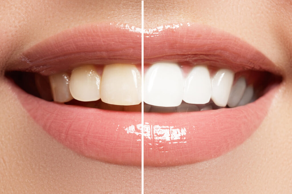 What is Teeth Bleaching? Complete Guide to Teeth Whitening