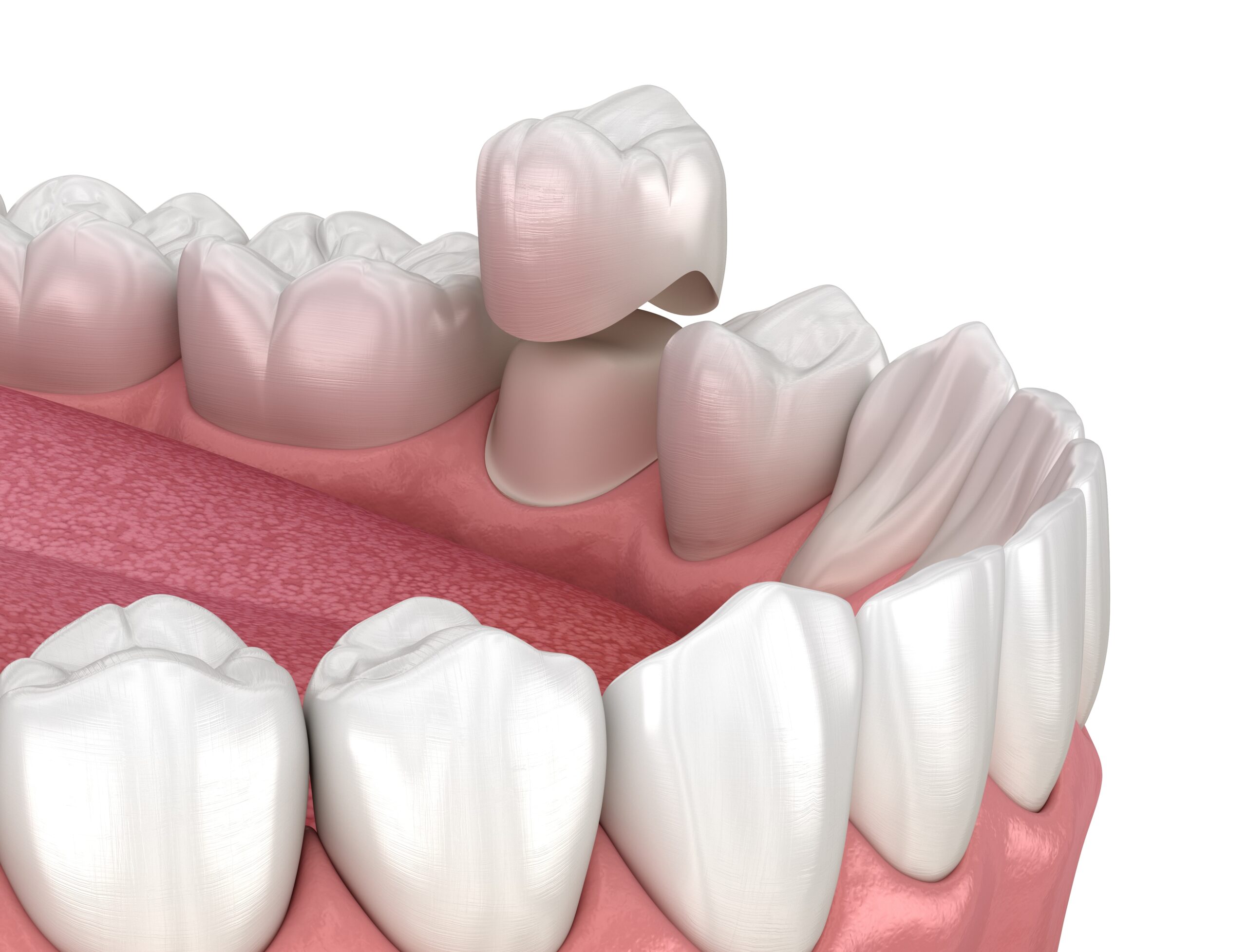 Veneers vs. Crowns: Which Option Is Right for You? - Experience Dentistry